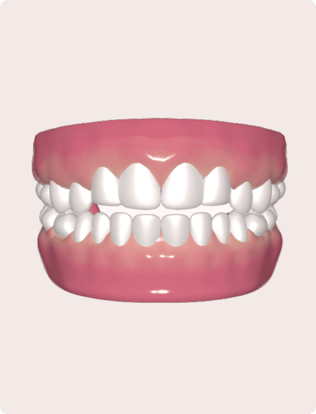 Overbite (protrude) Teeth: Causes, Risks, and Treatment - Dezy
